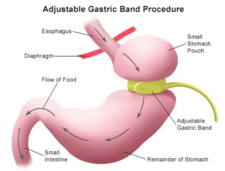 Gastric Band Surgery Procedure - MyMediTravel Knowledge